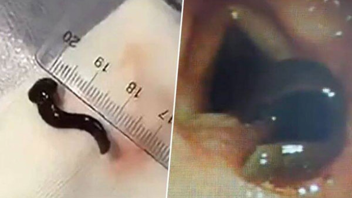 WATCH: 3-cm long live blood-sucking leech removed from woman’s throat ...