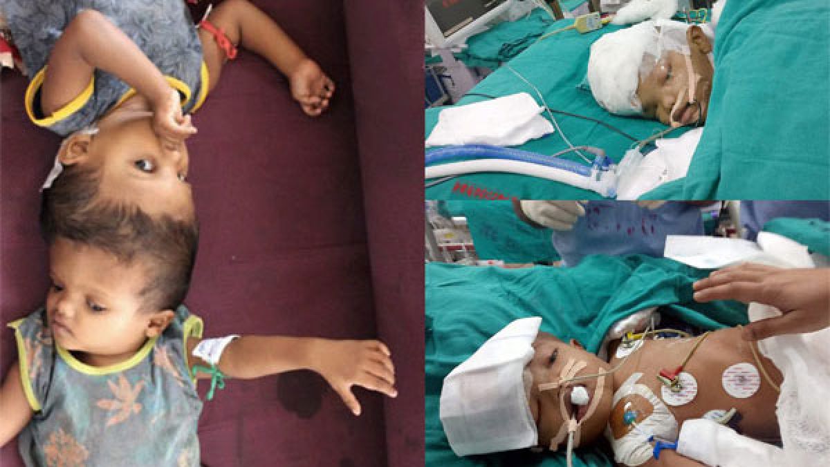 After 50 hours of surgery, conjoined twins joined at skull ...