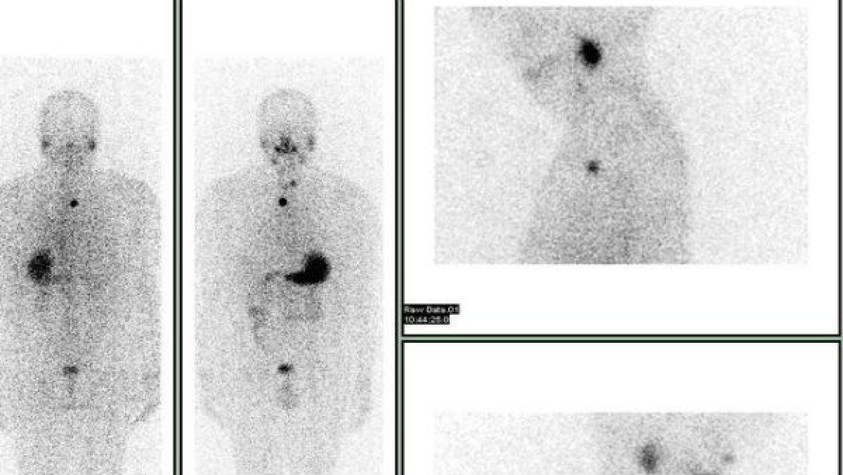 What is medical isotopes? - Oneindia News