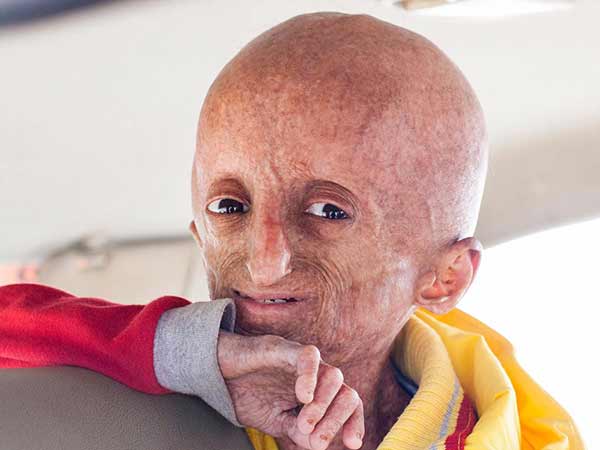 Nihal Bitla, the progeria disorder survivor, passes away - Oneindia