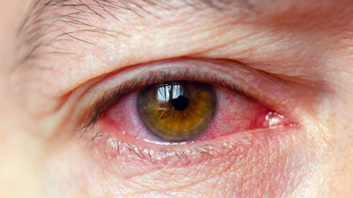 Amid Conjunctivitis, Eye Flu Surge, Doctors Warn Against Irrational Use Of Steroid Eye Drops ...