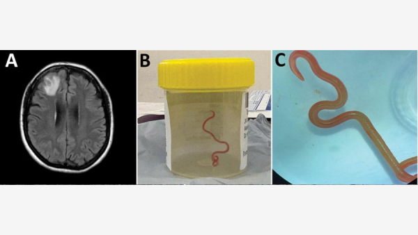 First-Of-Its-Kind: 8 cm Live Worm Found In 64-Year-Old Australian Woman ...