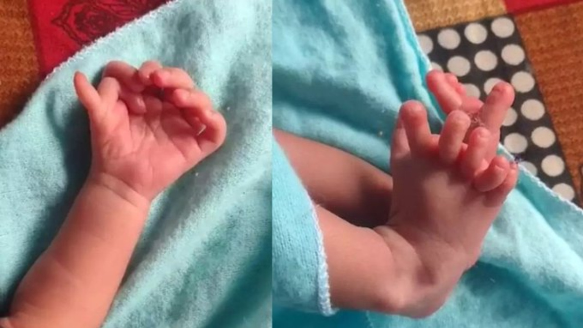 Baby Girl Born With 26 Fingers And Toes In Rajasthan, Family Believes ...