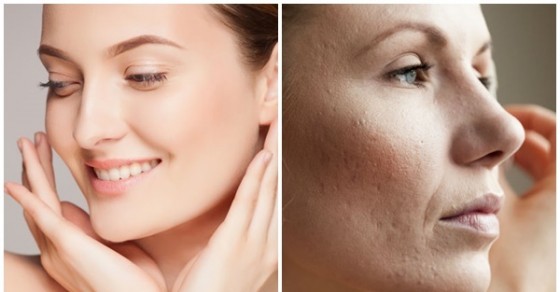 Here are some simple tips to clear pimples caused by dandruff | Pimple ...