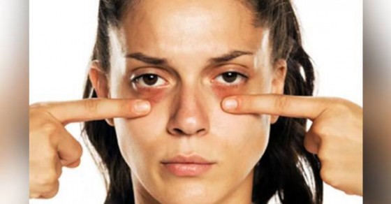 Beauty tips: Dark circles around the eyes; Here are some easy ways to ...